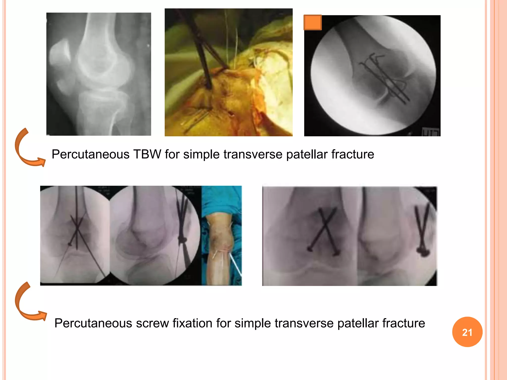 Percutaneous treatment of communited patellar fracture.pptx