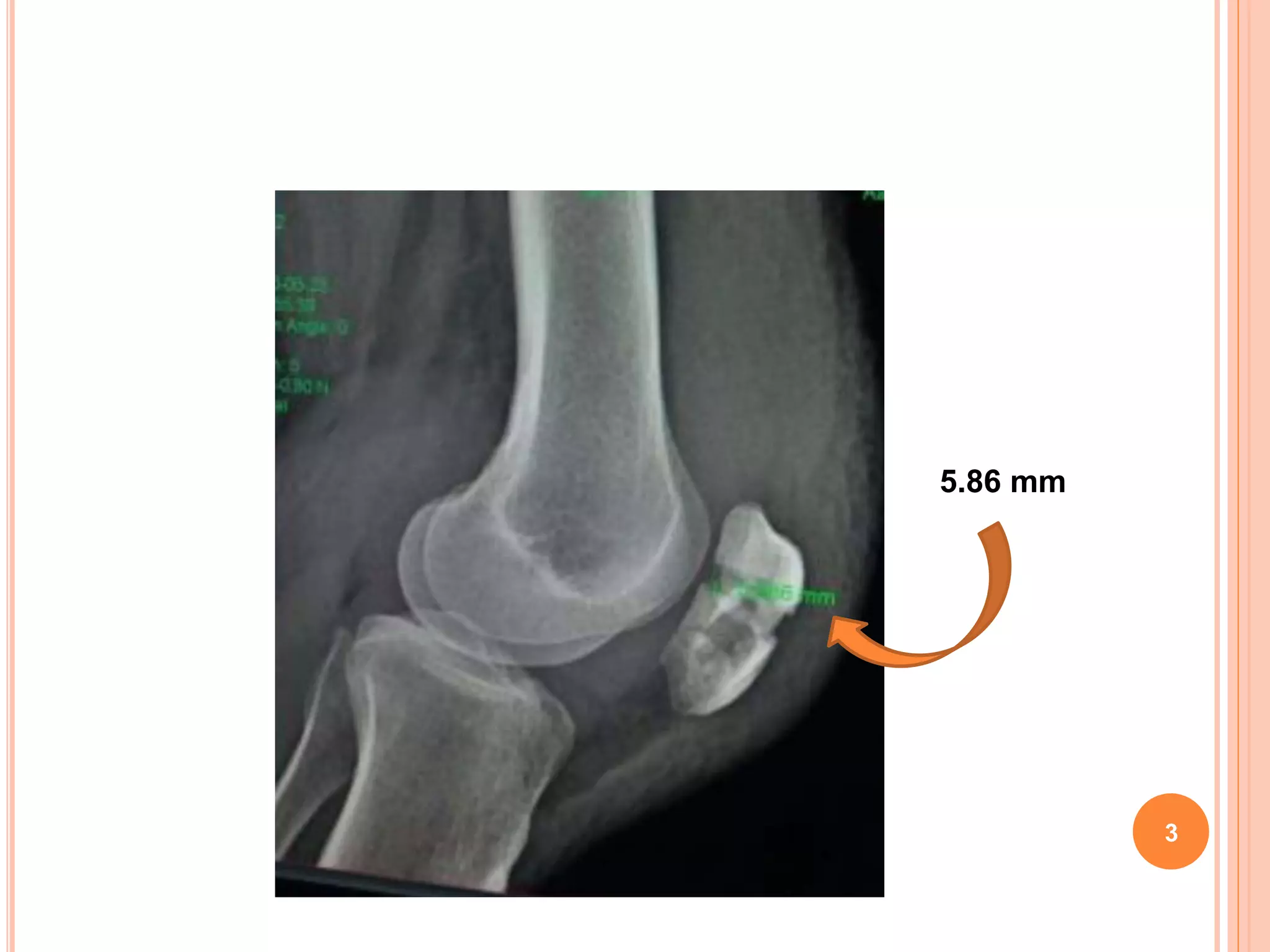 Percutaneous treatment of communited patellar fracture.pptx