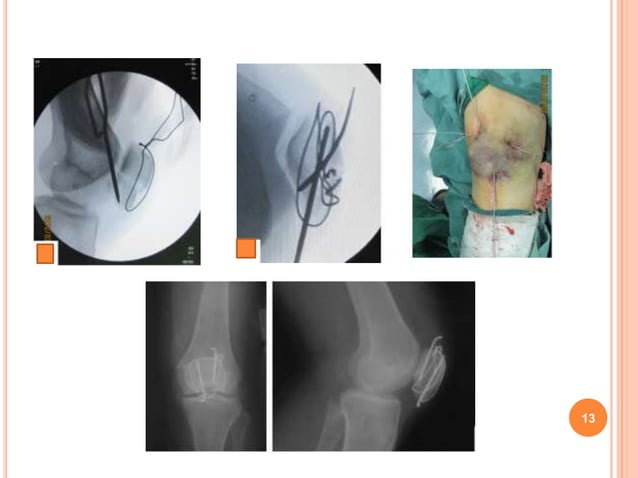 Percutaneous treatment of communited patellar fracture.pptx