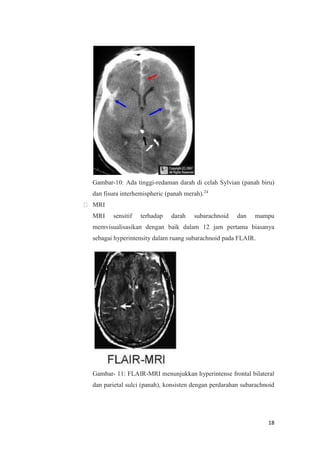 PERDARAHAN_INTRAKRANIAL.docx