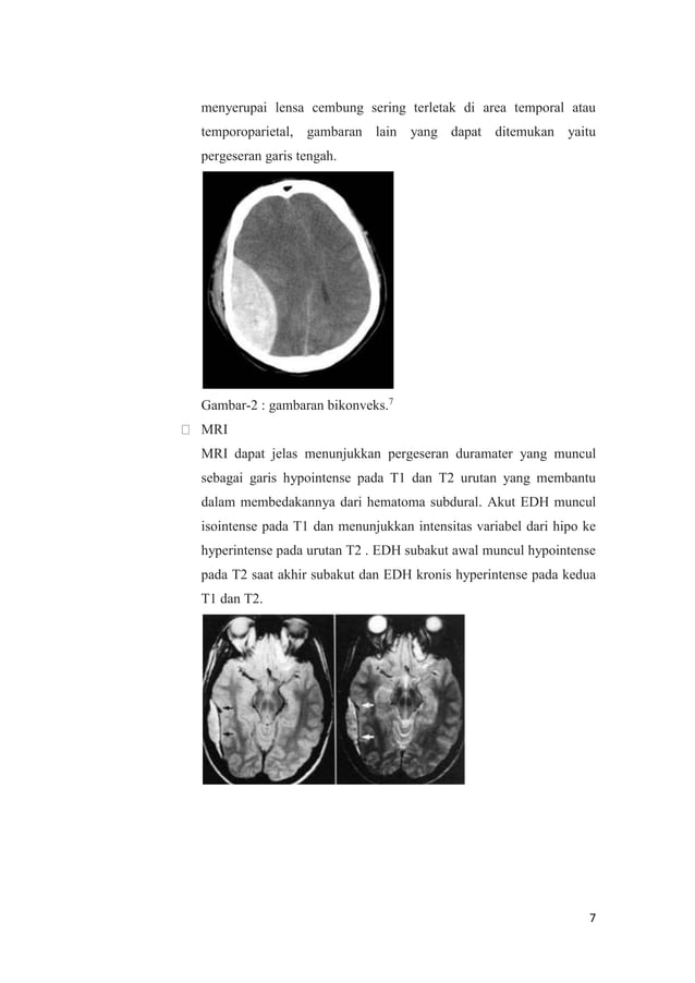 PERDARAHAN_INTRAKRANIAL.docx