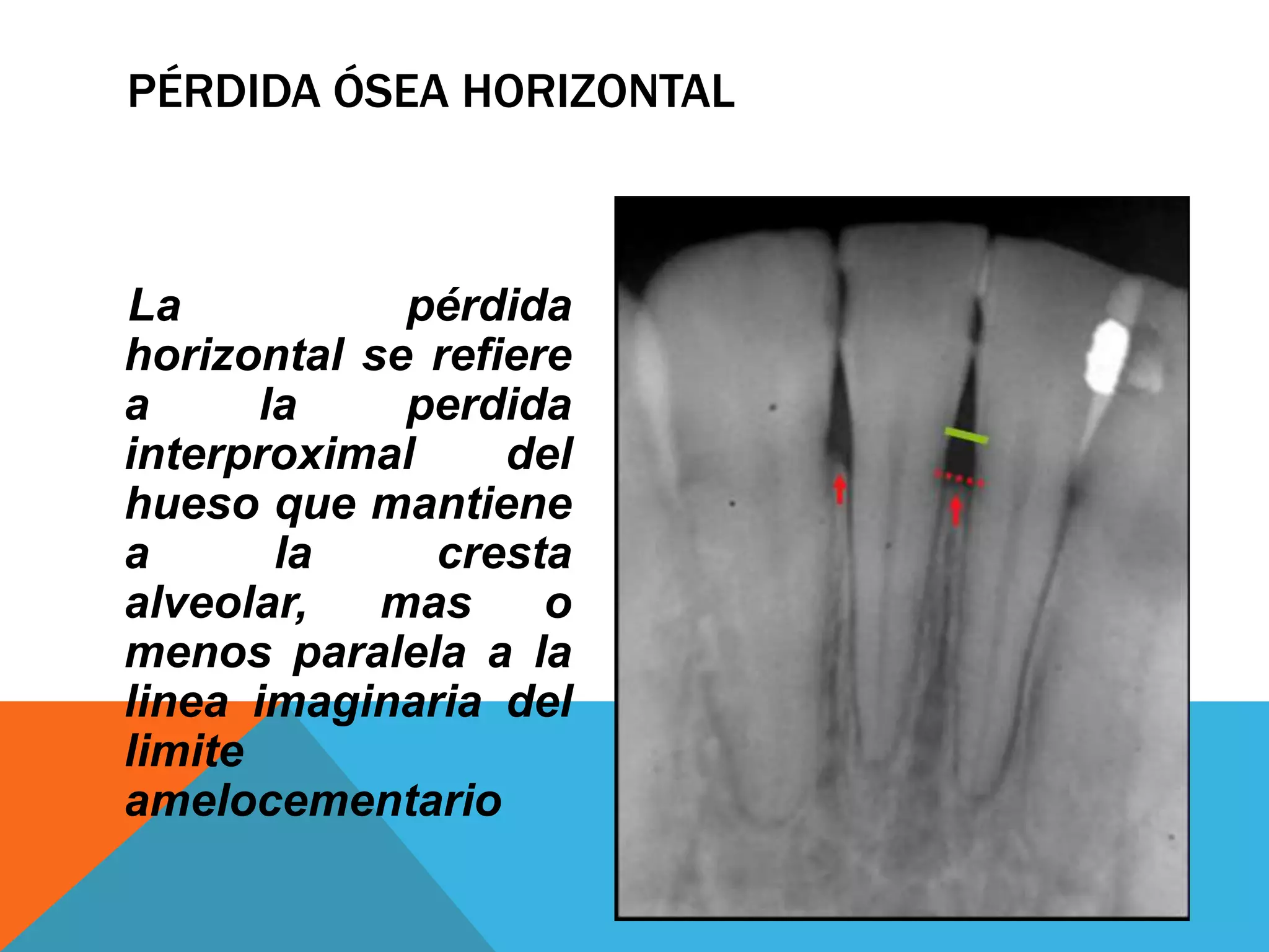 Perdida osea alveolar | PPT