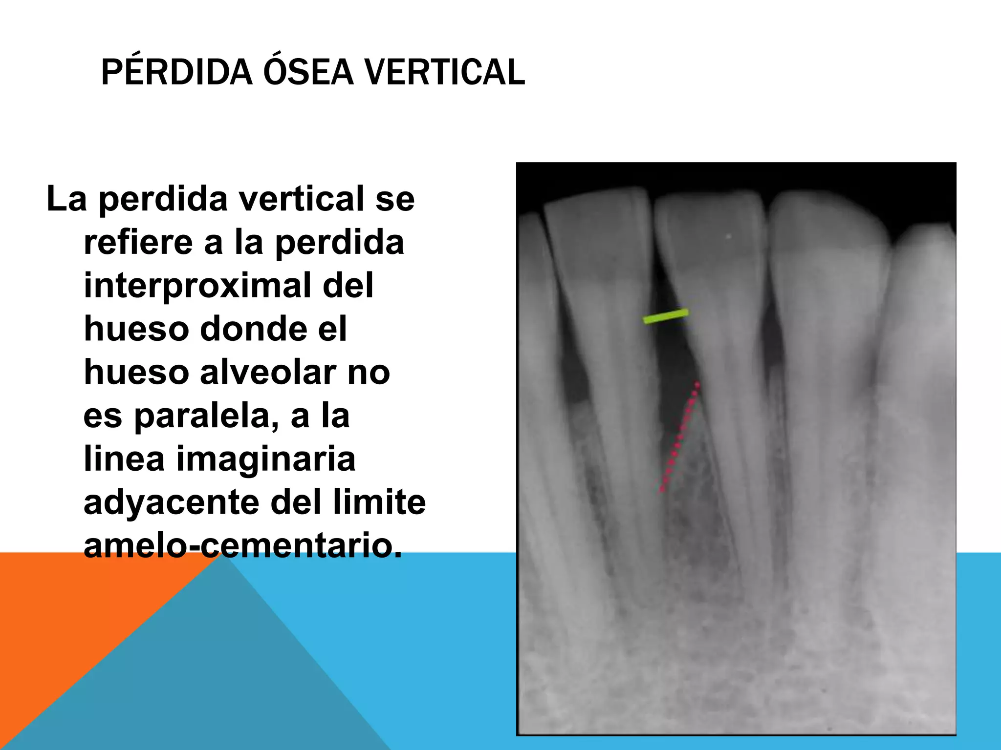 Perdida osea alveolar