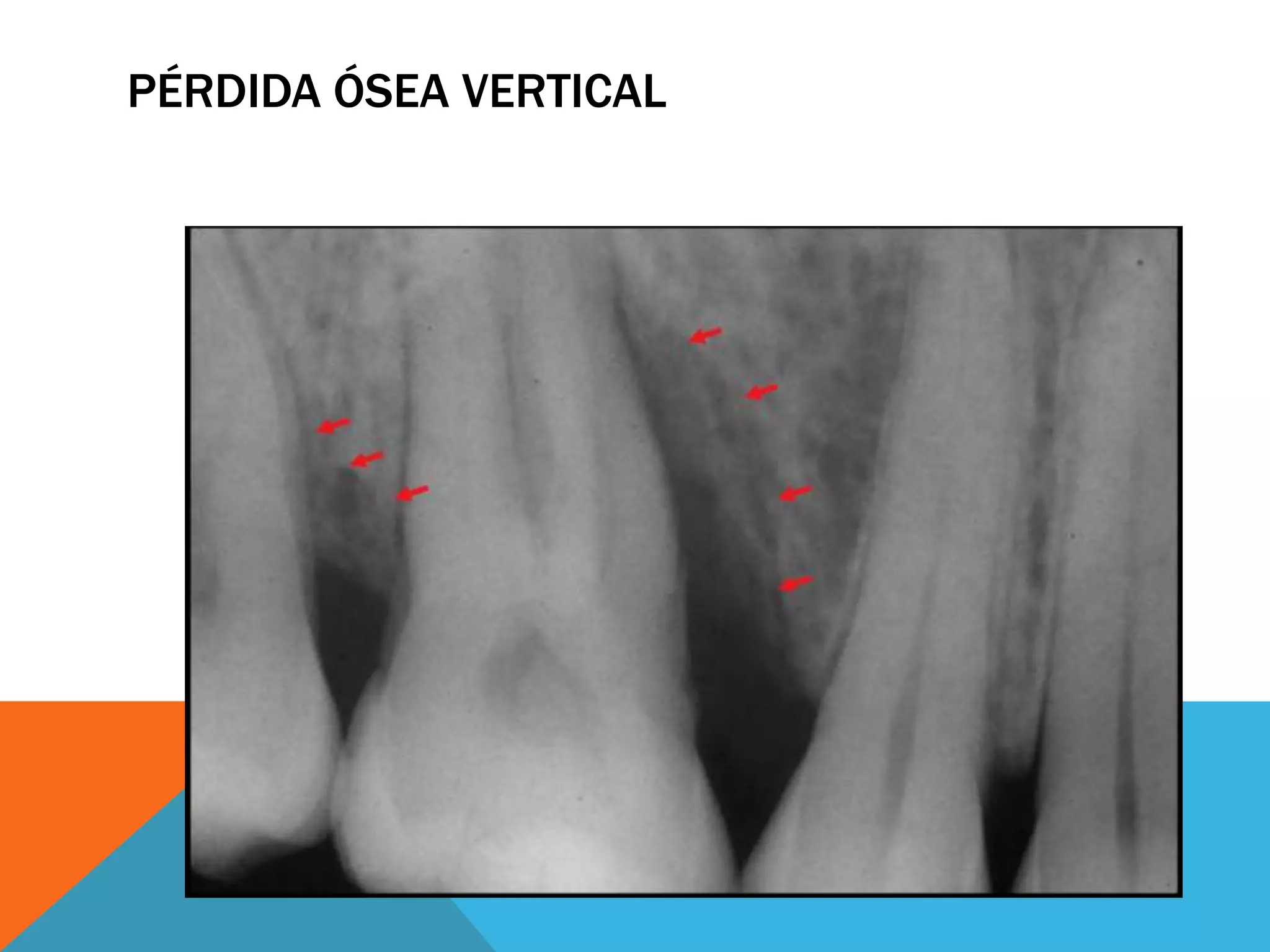 Perdida osea alveolar