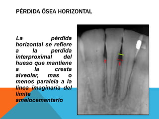 Perdida osea alveolar
