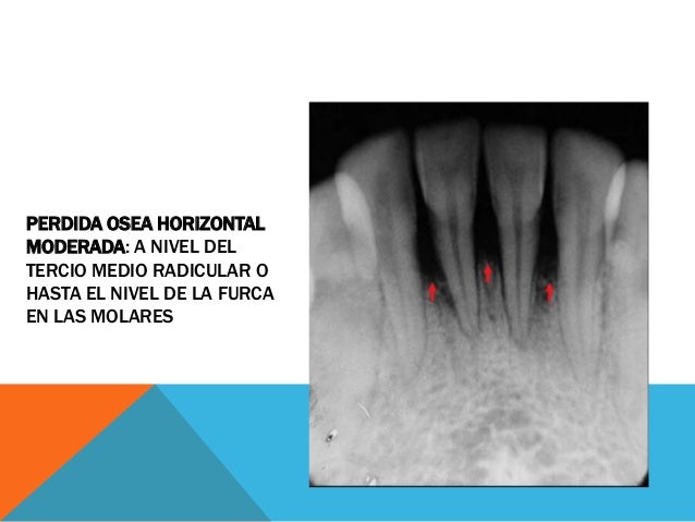 Perdida osea alveolar