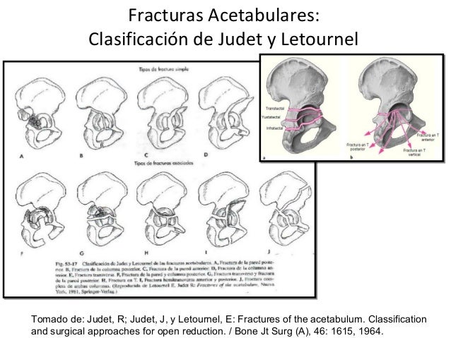 Perez Garcia. Nuestra experiencia en las fracturas periacetabulares c…