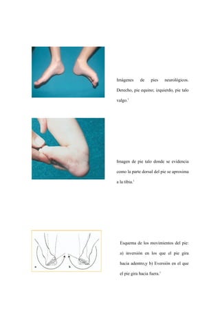 monografia Pie Plano,displasia congénita de la cadera | DOC