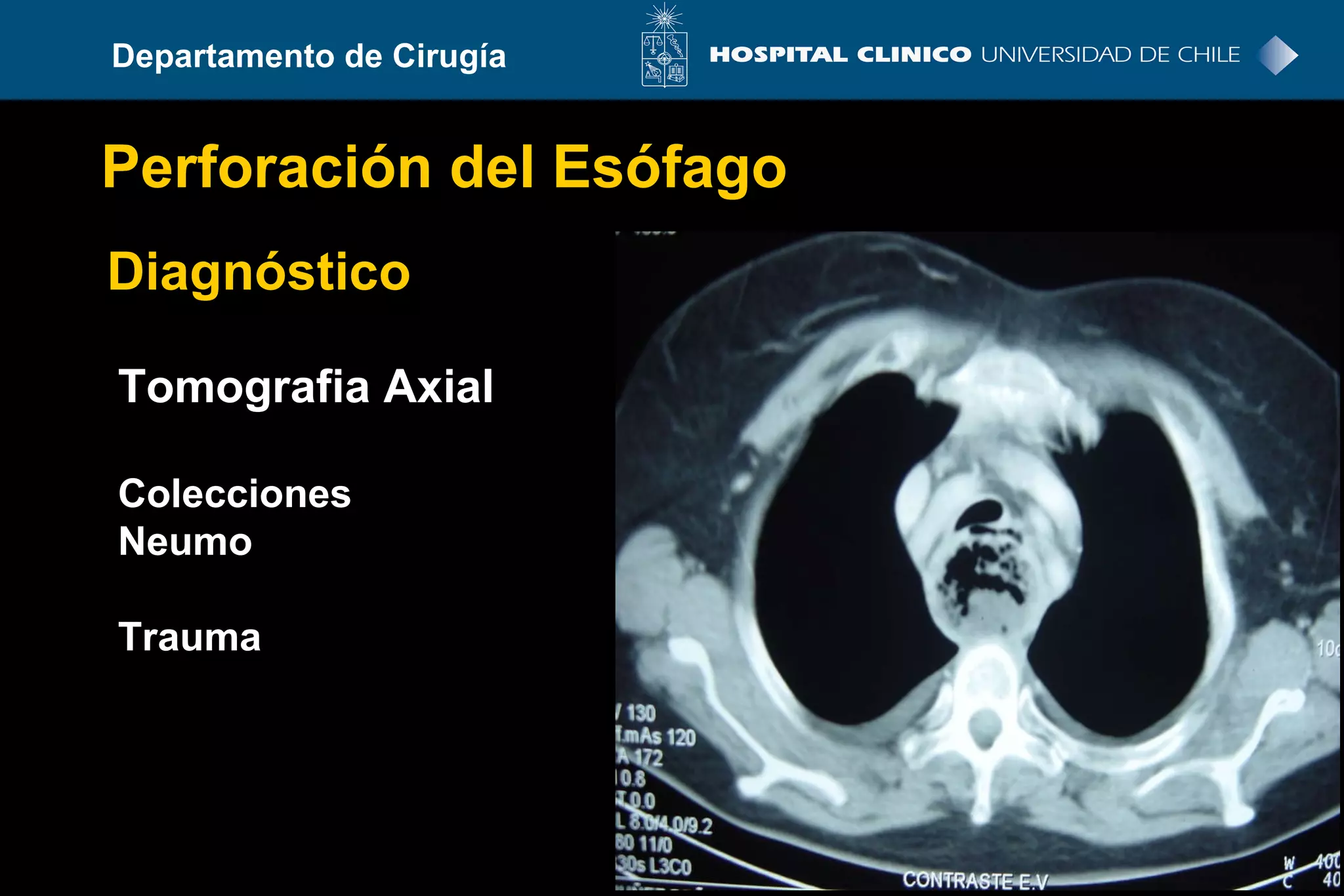 Perforación esofago | PPT | Death, Injury, or Military Conflict ...