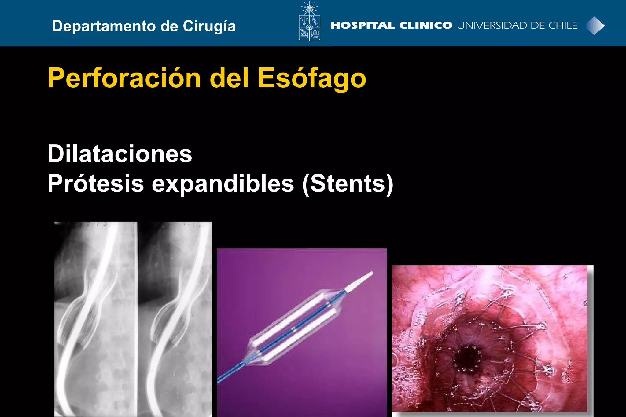 Perforación esofago | PPT | Death, Injury, or Military Conflict ...