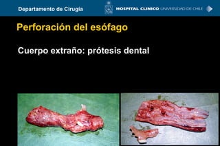 Perforación esofago | PPT