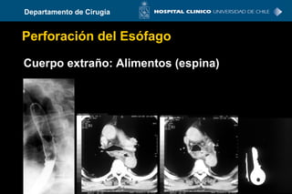Perforación esofago | PPT