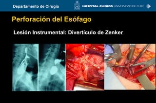 Perforación esofago | PPT