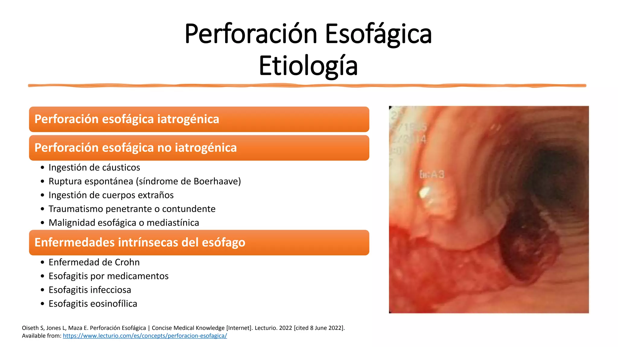 Perforación Esofágica - Cirugia UP - AH.pptx