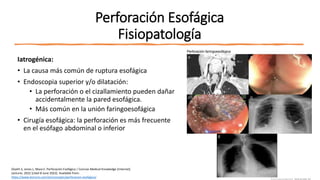 Perforación Esofágica - Cirugia UP - AH.pptx