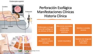 Perforación Esofágica - Cirugia UP - AH.pptx