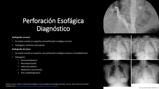 Perforación Esofágica - Cirugia UP - AH.pptx