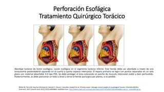 Perforación Esofágica - Cirugia UP - AH.pptx