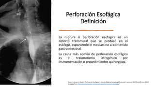 Perforación Esofágica - Cirugia UP - AH.pptx