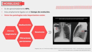 Perforacion esofagica | PPTX