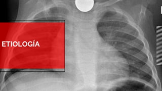 Perforacion esofagica | PPTX