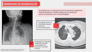 Perforacion esofagica | PPTX