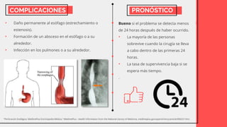 Perforacion esofagica | PPTX