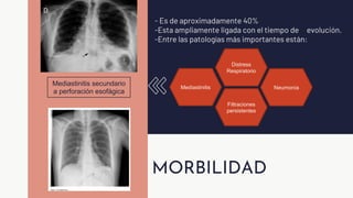 Perforacion esofagica | PDF