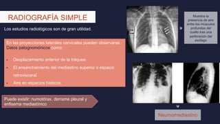 Perforacion esofagica | PDF