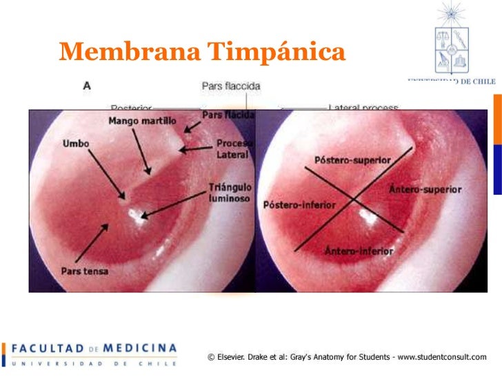 Perforación Timpánica
