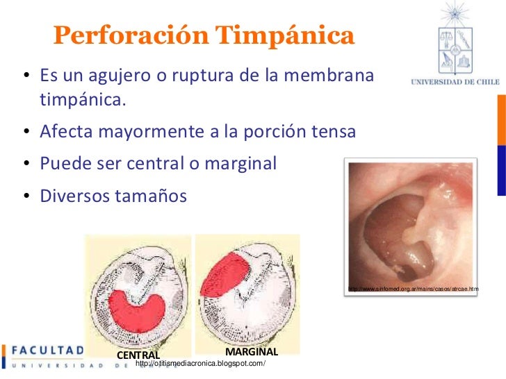Tratamento De Membrana Timpanica Rompida