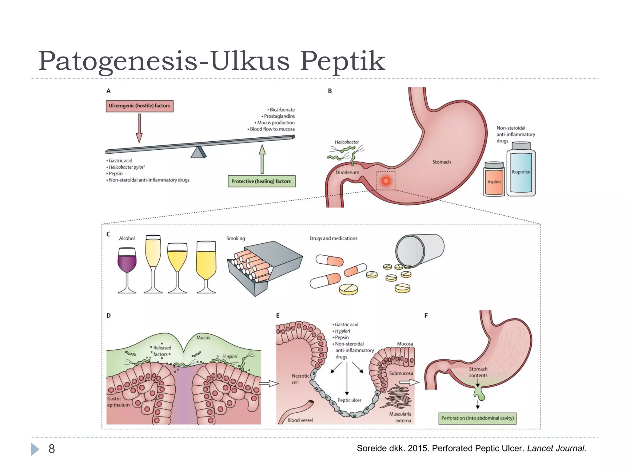 Perforasi gaster | PPT