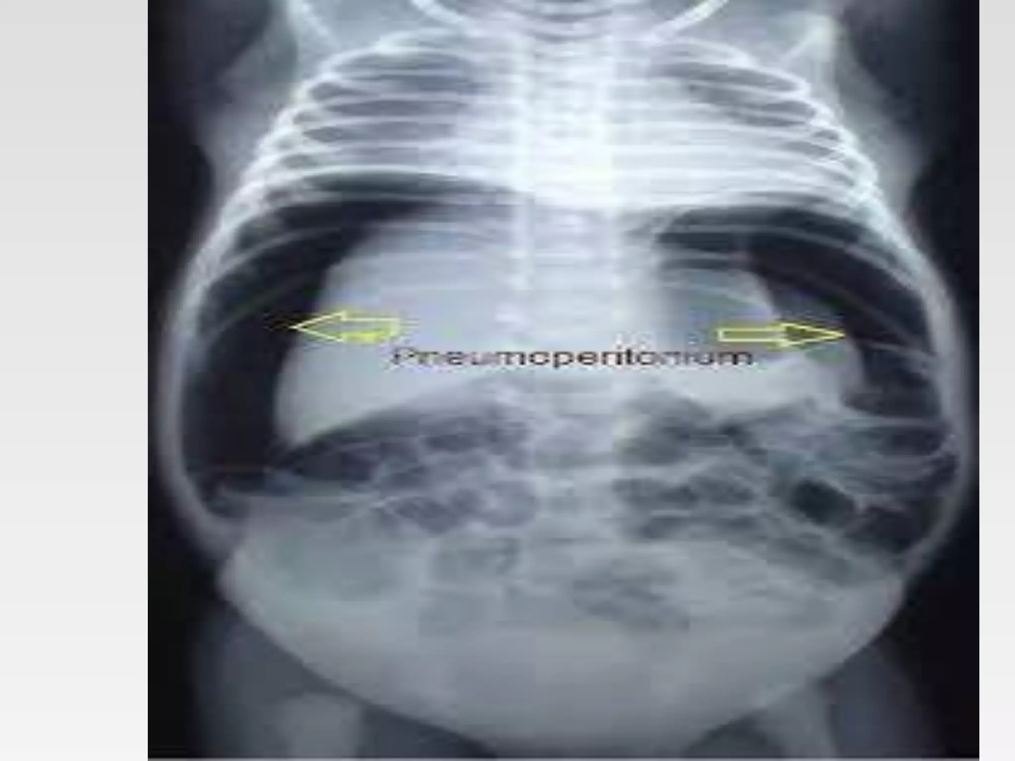 Perforated peptic ulcer.pptx