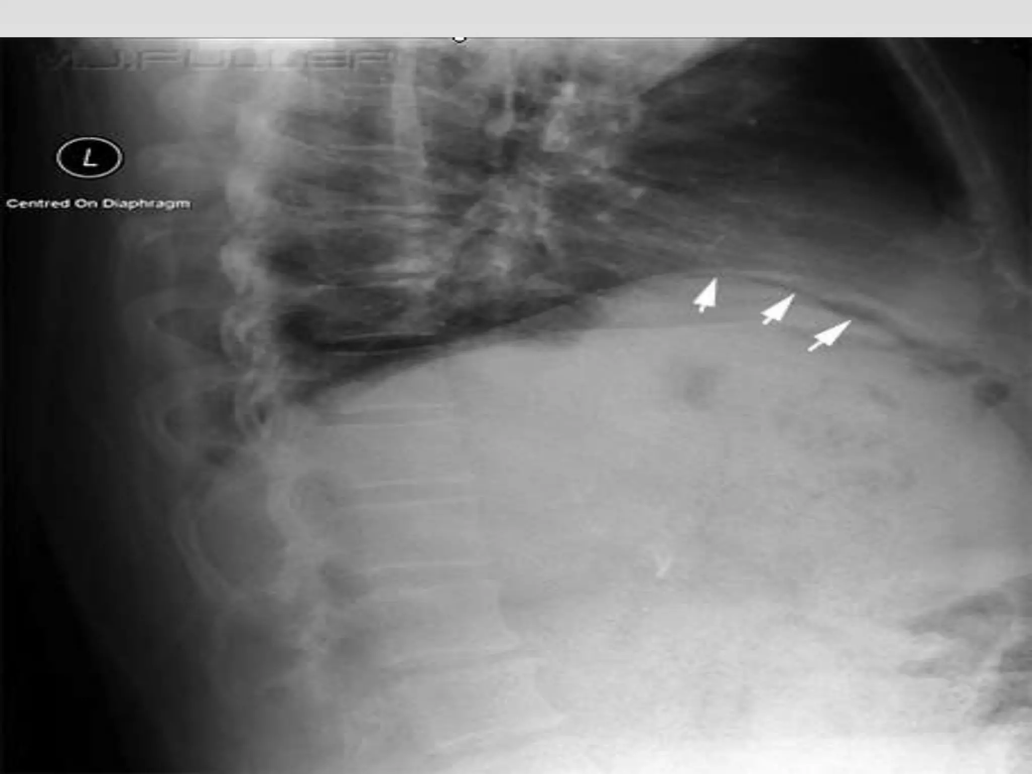 Perforated peptic ulcer.pptx