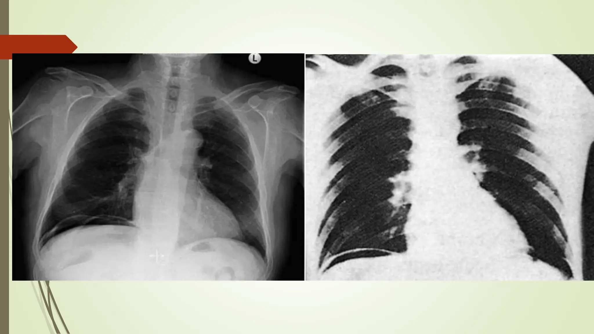 Perforated Peptic Ulcer.pptxuyfufhgdssgshdh | PPTX | Digestive ...