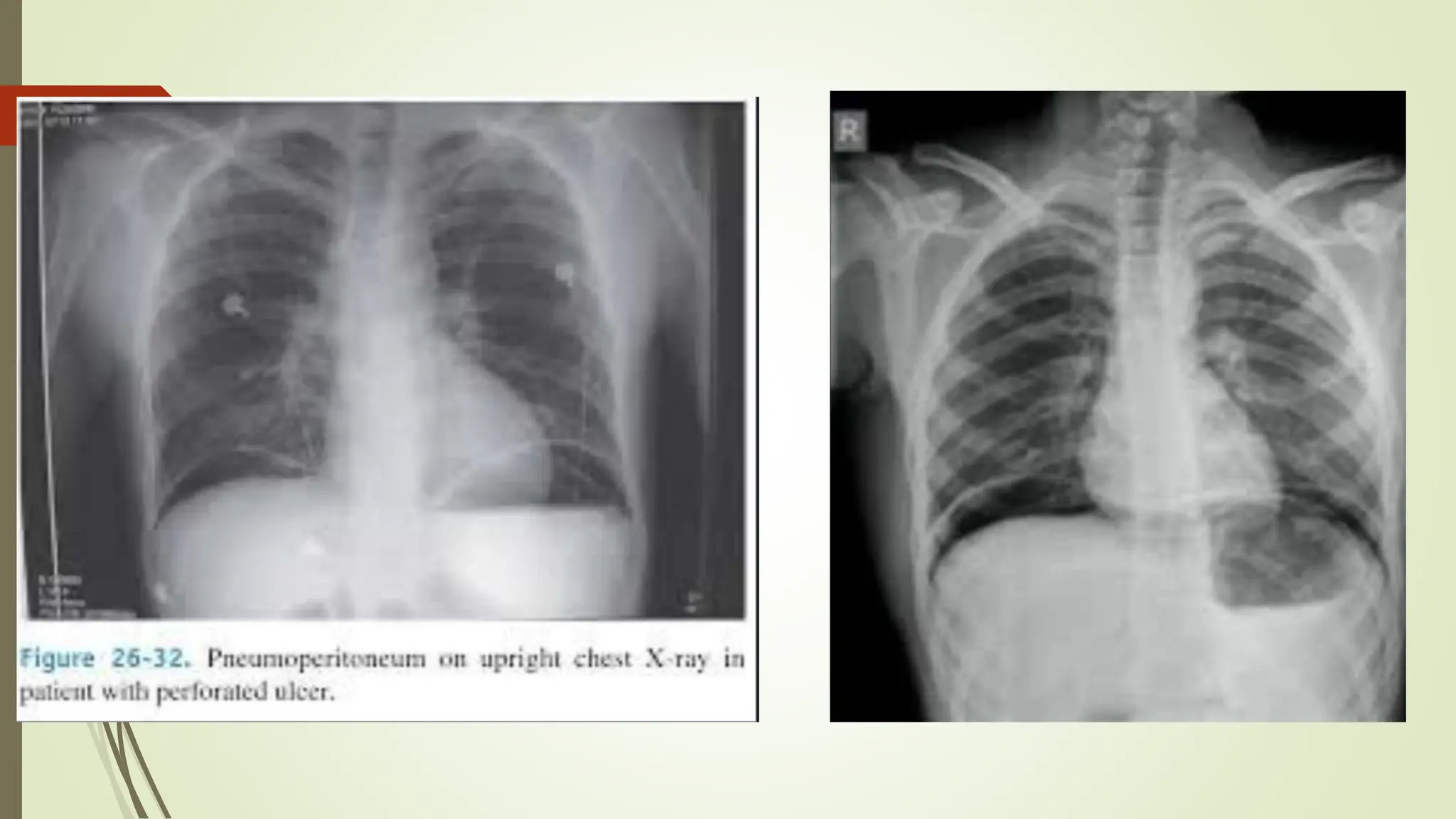 Perforated Peptic Ulcer.pptxuyfufhgdssgshdh | PPTX | Digestive ...