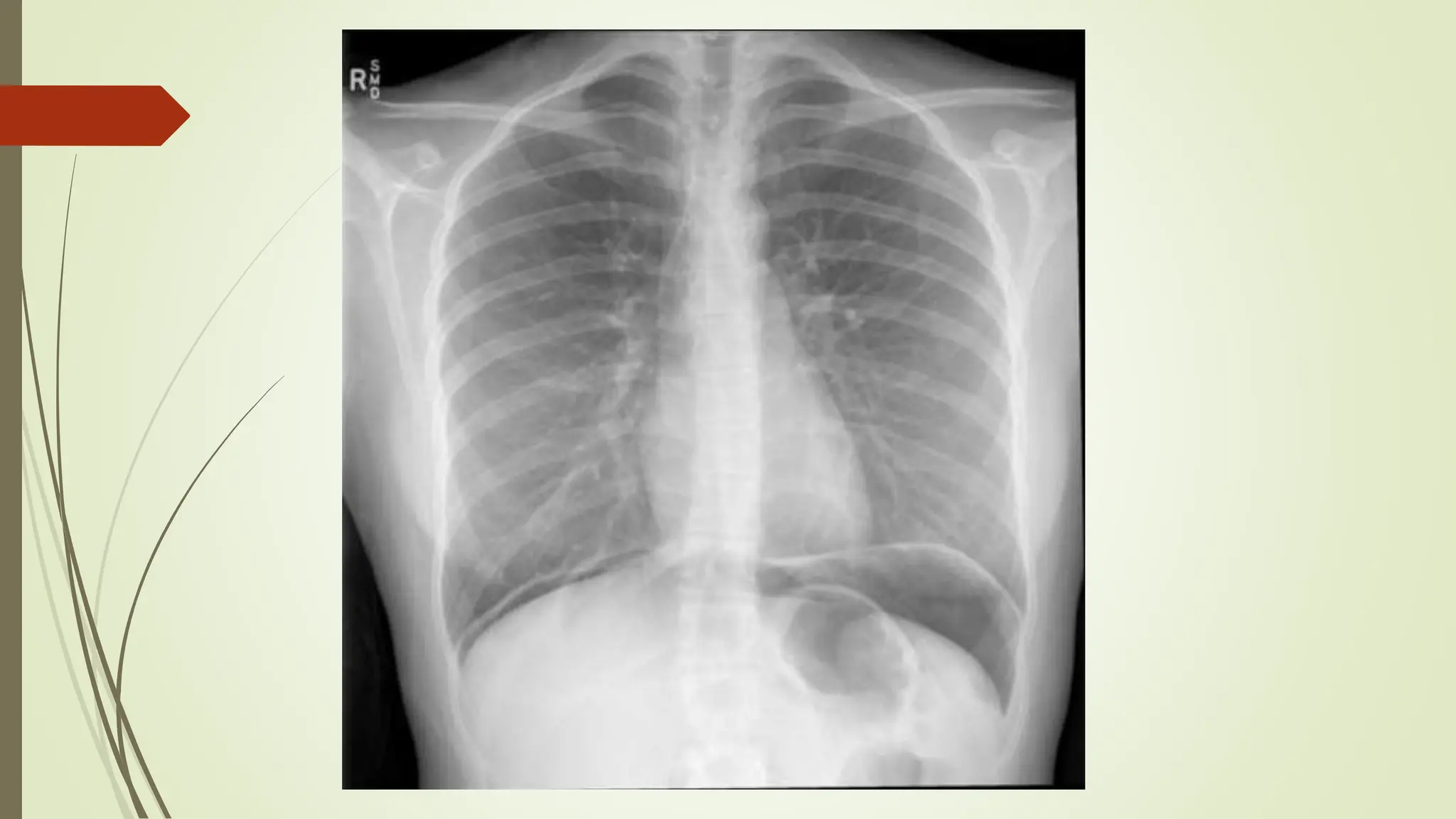 Perforated Peptic Ulcer.pptxuyfufhgdssgshdh | PPTX | Digestive ...