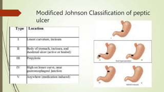 Perforated Peptic Ulcer.pptxuyfufhgdssgshdh | PPTX | Digestive ...