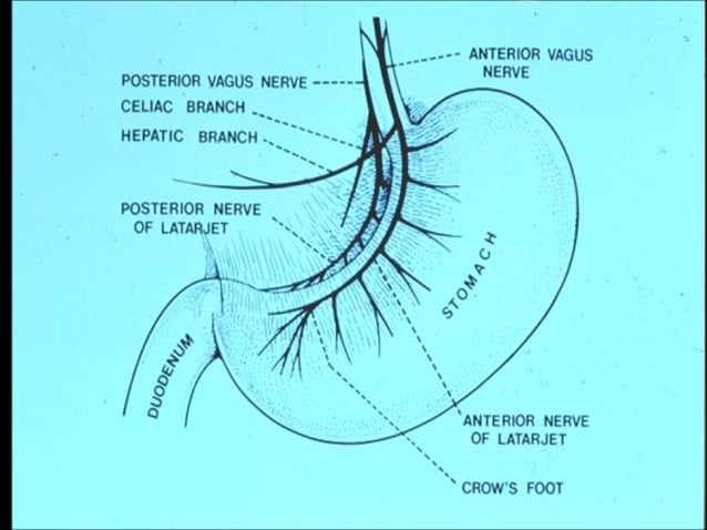 Perforated peptic ulcers | PPT | Digestive Disorders | Diseases and ...