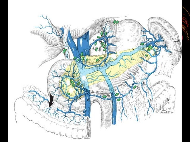 Perforated peptic ulcers | PPT | Digestive Disorders | Diseases and ...