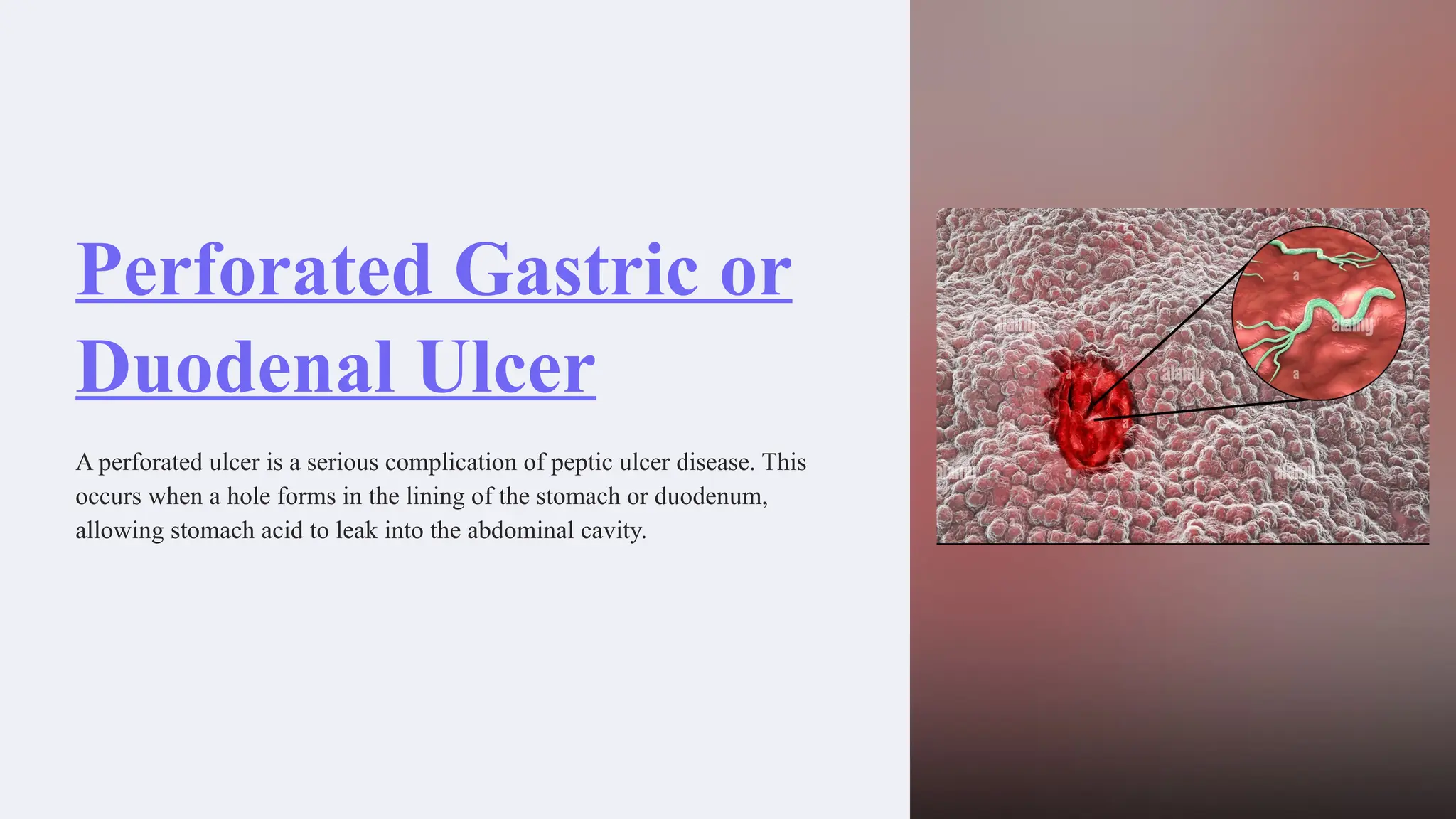 perforated ulcer of stomach and duodenum. kuldeep Singh 4039 copy copy.pptx