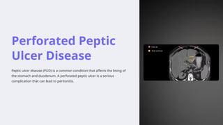 perforated ulcer of stomach and duodenum. kuldeep Singh 4039 copy copy.pptx