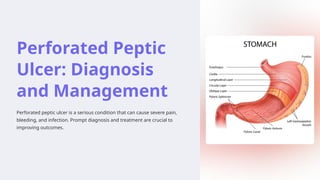 perforated ulcer of stomach and duodenum. kuldeep Singh 4039 copy copy.pptx