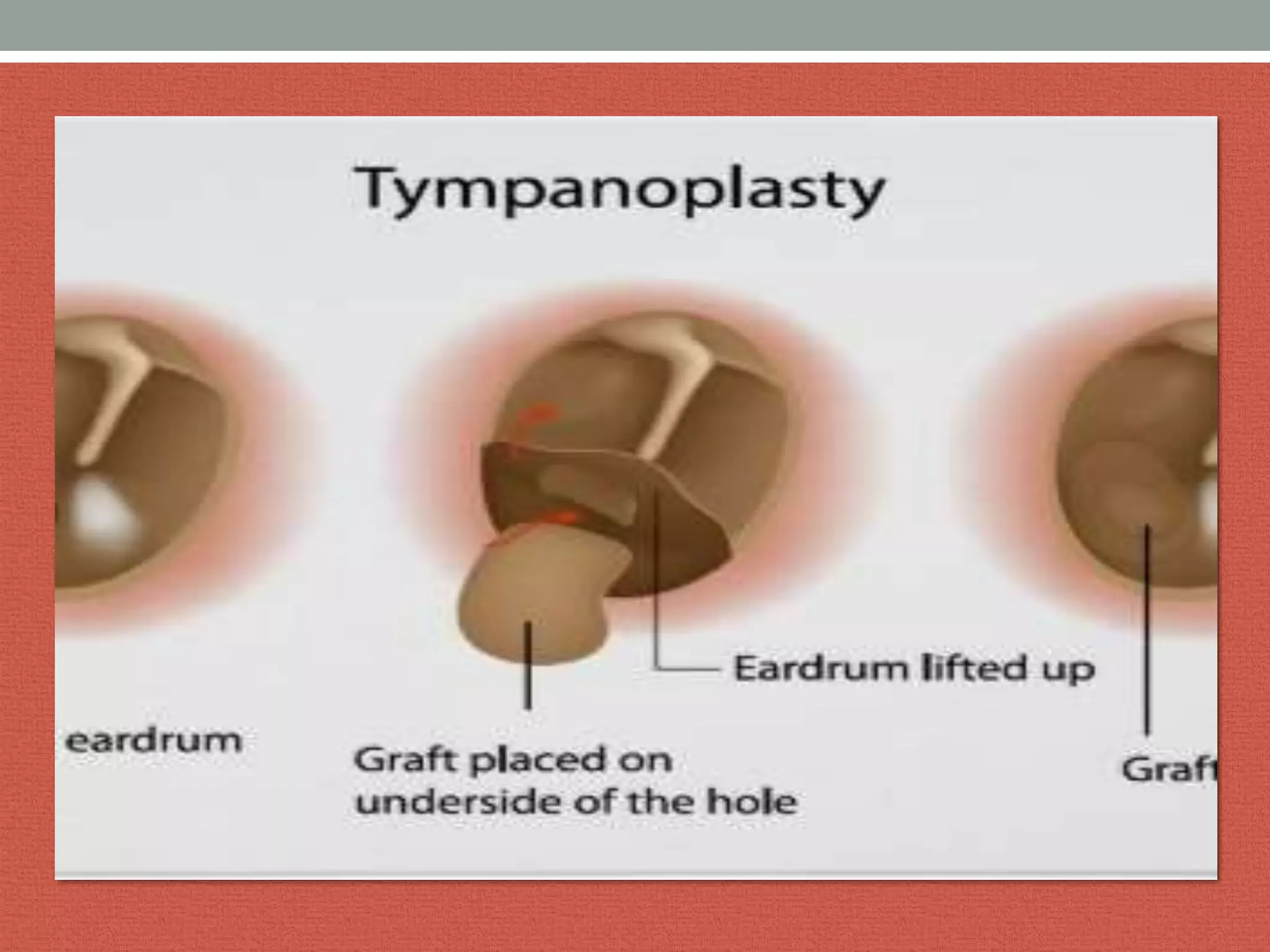 perforation of ear drum.pptx
