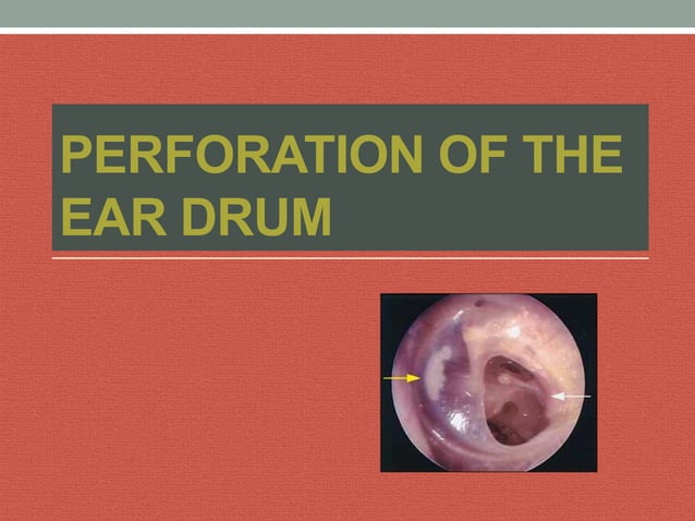 perforation of ear drum.pptx