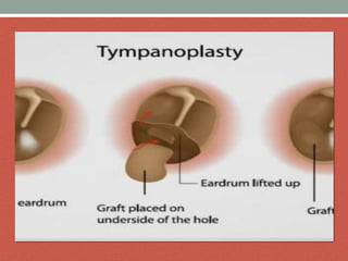 perforation of ear drum.pptx