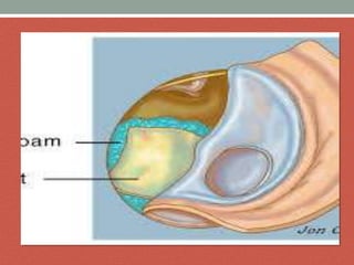 perforation of ear drum.pptx