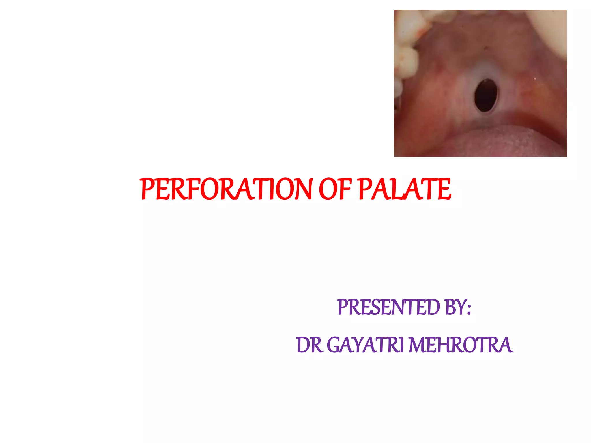 Perforation of palate | PPTX