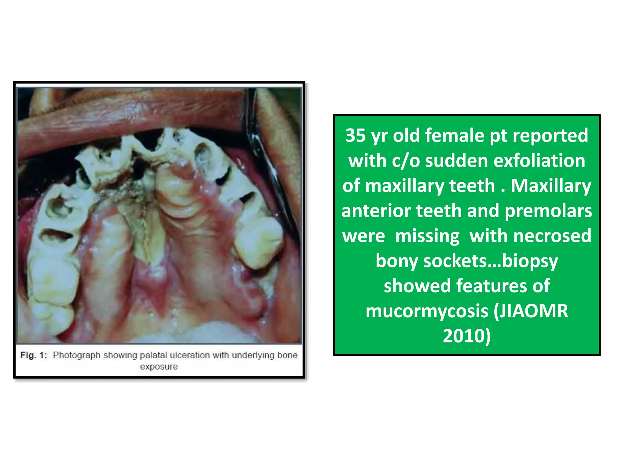 Perforation of palate | PPTX
