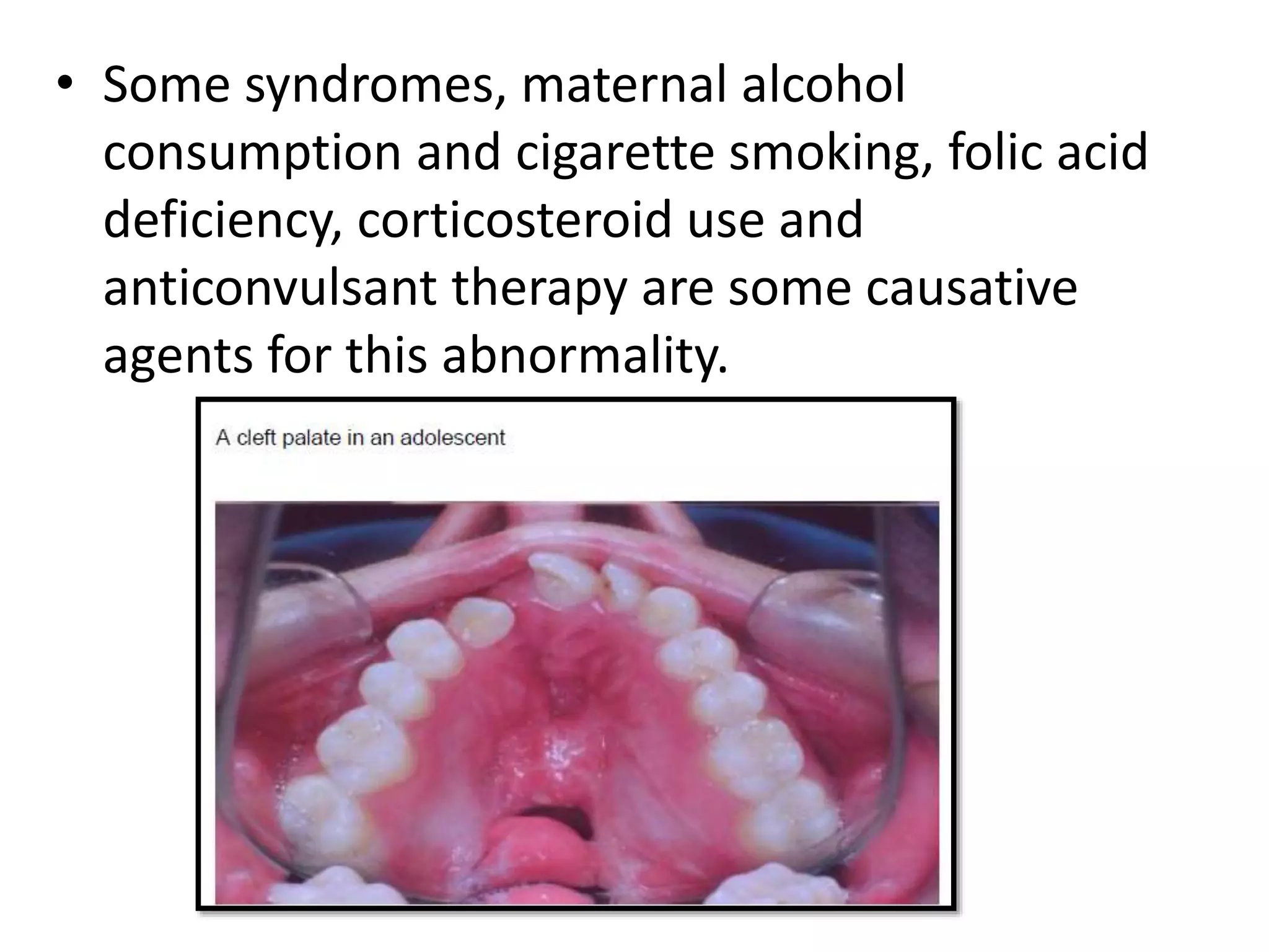 Perforation of palate | PPTX